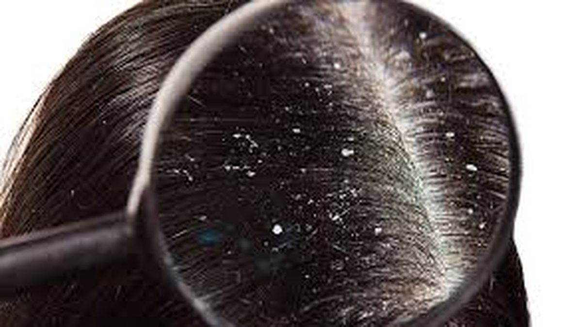 Cómo deshacerse de la caspa de manera natural