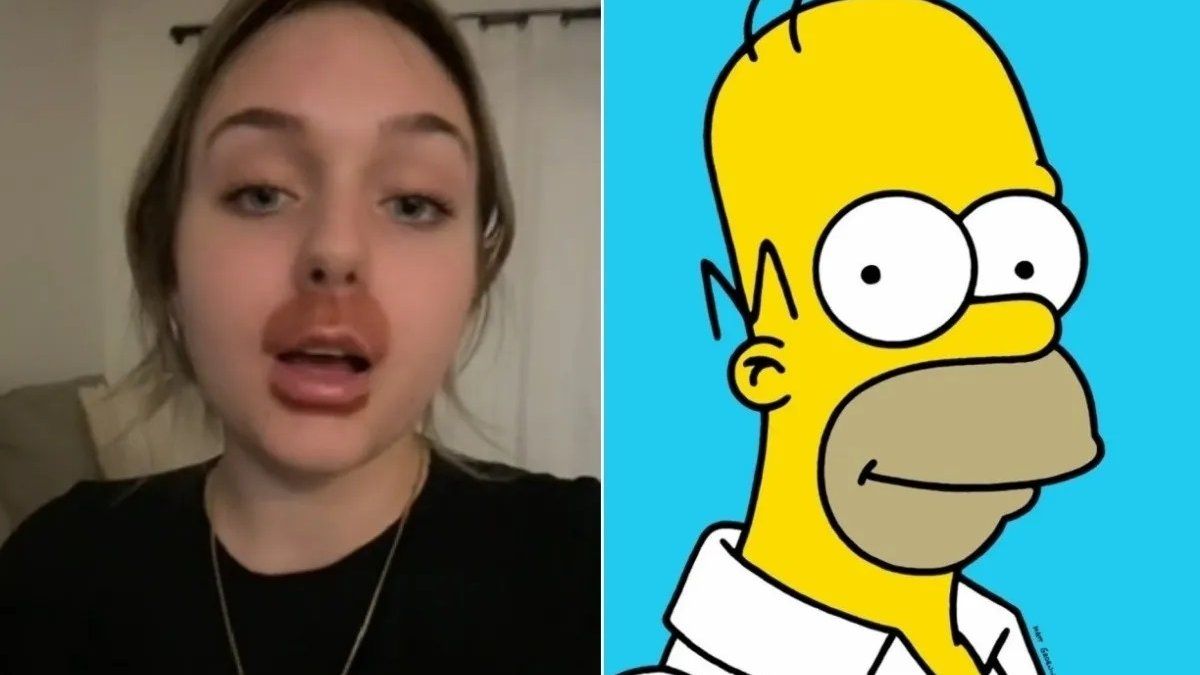 Se hizo un tratamiento en los labios y ahora la comparan con Homero Simpson