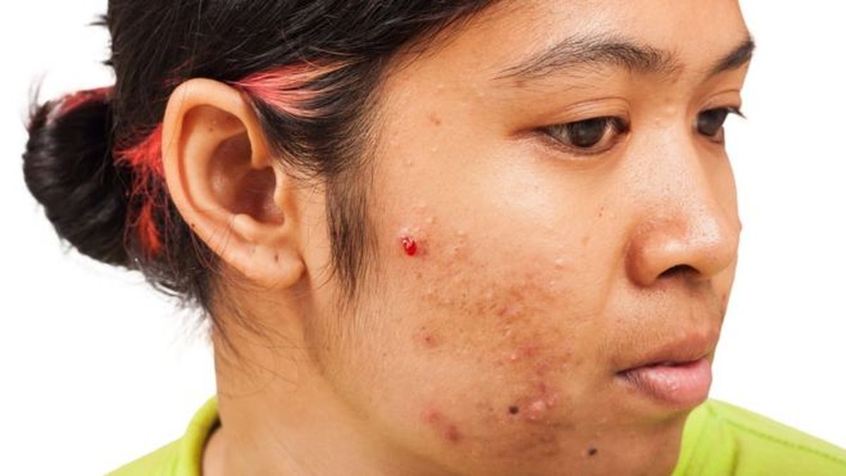 Qué es el “superacné” y cómo tratarlo