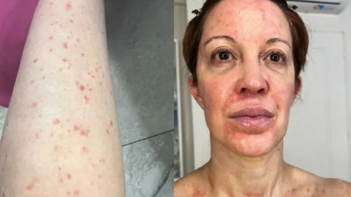 Miriam Lanzoni reveló la enfermedad que padeció y compartió impactantes ...