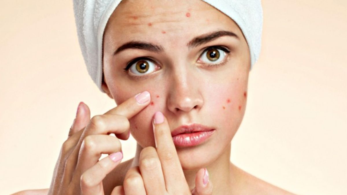 5 razones por las que no pudiste superar el acné