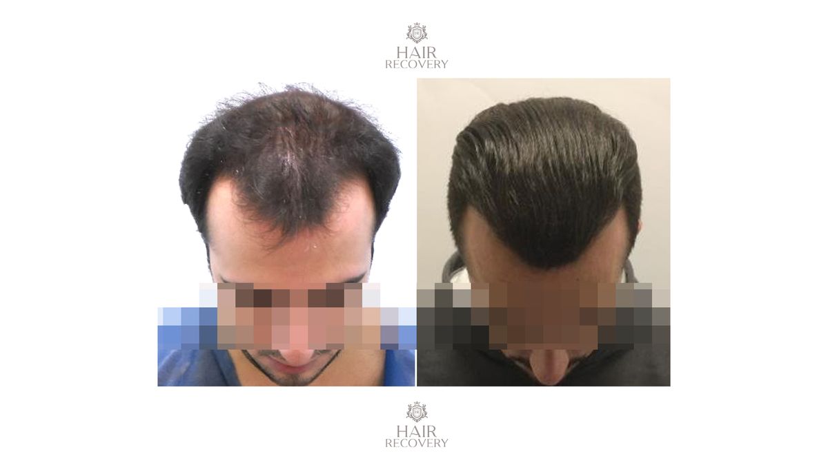 Se triplican las consultas capilares en Hair Recovery Santa Fe