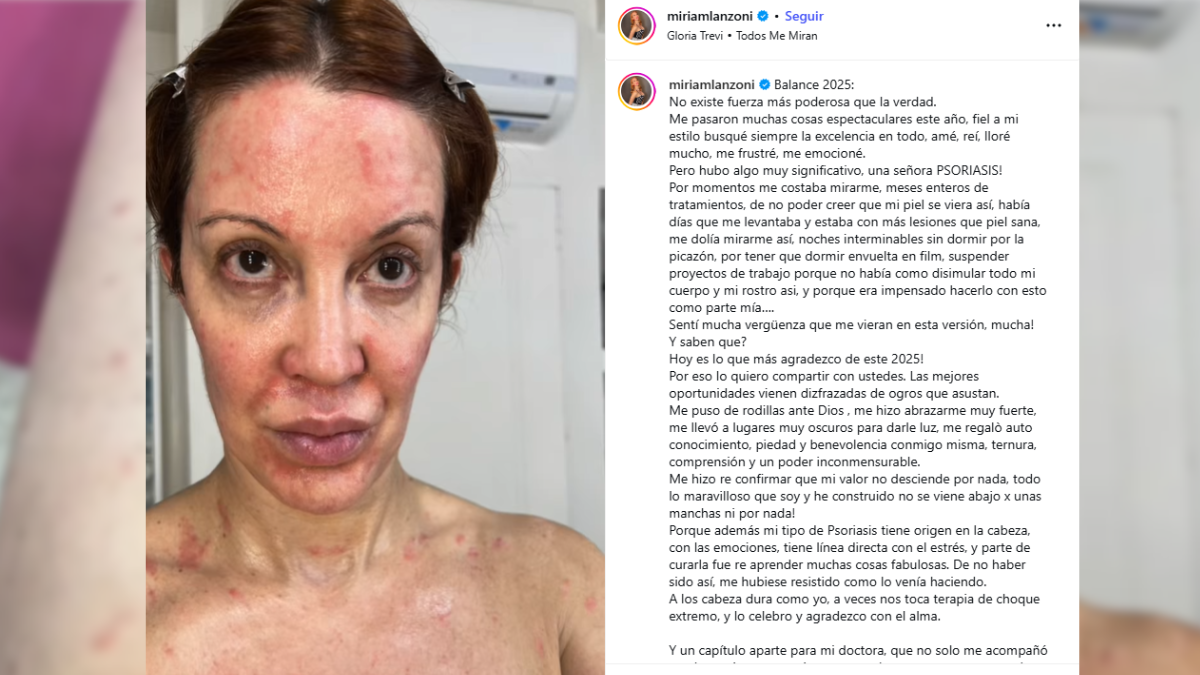 Miriam Lanzoni reveló la enfermedad que padeció y compartió impactantes ...