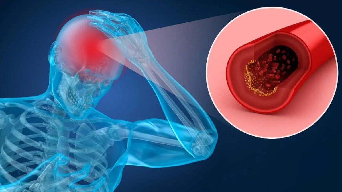 ACV: cuánto sabemos los argentinos de los síntomas, tratamiento y ...